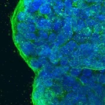 Am J Hum Genet：浙江大学发现了100多个新的乳腺癌靶标！_凤凰网健康_凤凰网