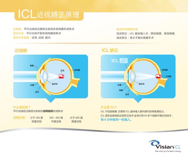 不适合准分子激光矫正近视？ICL了解一下！_凤凰网健康_凤凰网