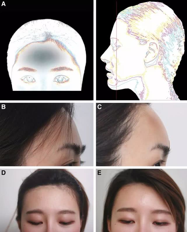 PRS最新：韩国医生实践:用CaHA丰额 患者满意度高__凤凰网